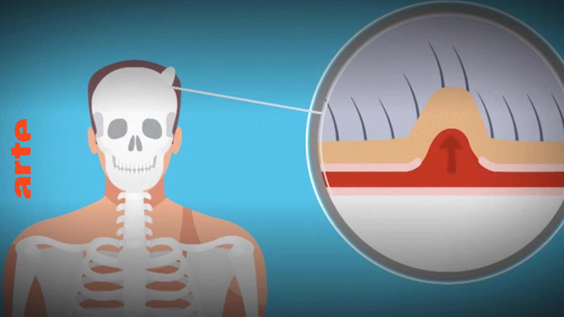 Wie entstehen Beulen? - Die ganze Doku | ARTE